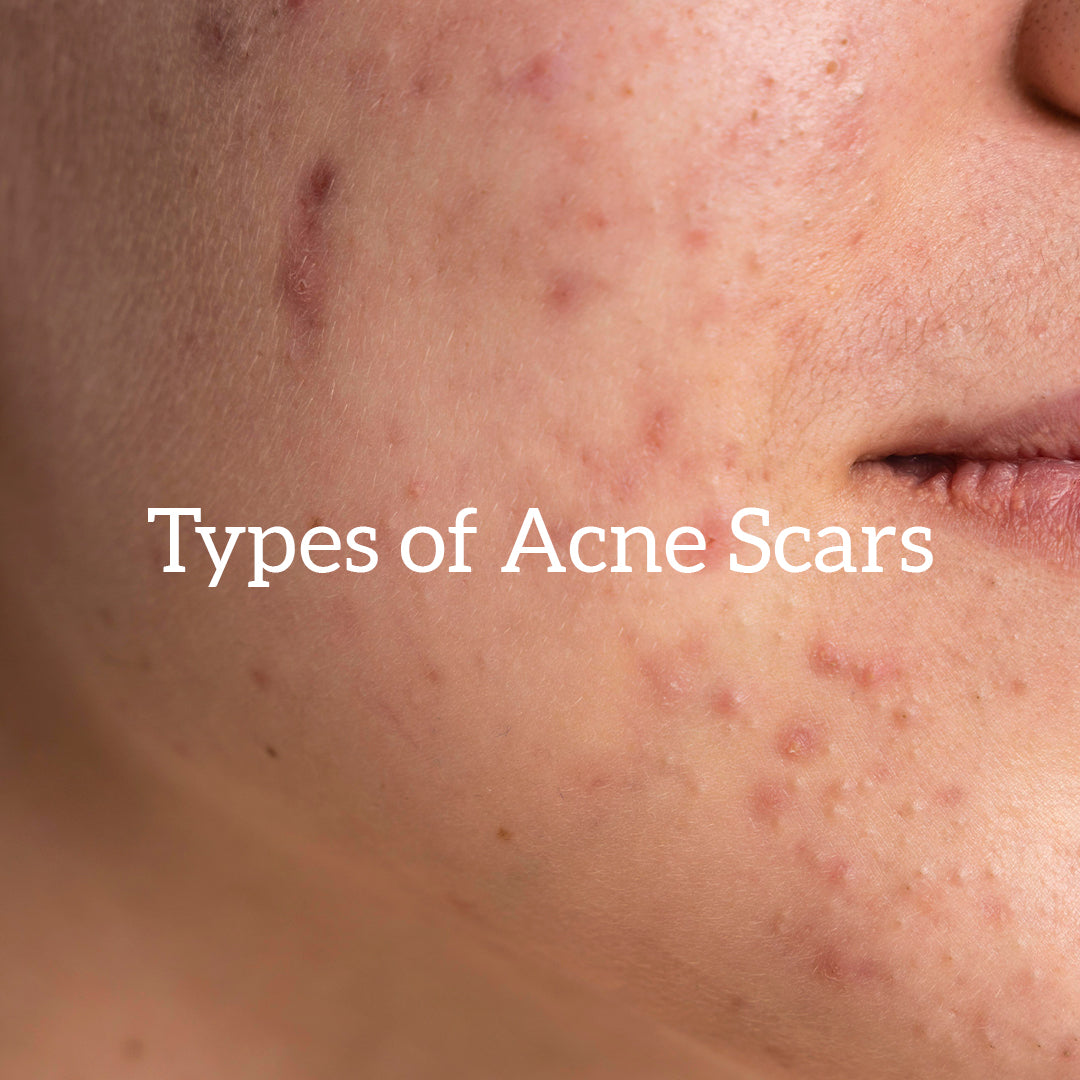 Types of Acne Scars (And How to Treat Them) – Joi